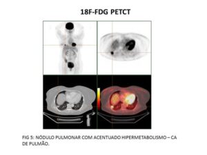 PET/CT 18F-FDG - Dimen Medicina Nuclear