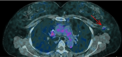 PET/CT Oncológico com 18F-FES - Fluoroestradiol - Dimen Medicina Nuclear