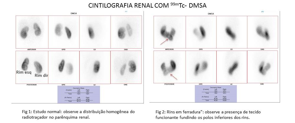 Cintilografia Renal Estática (Quantitativa/Qualitativa) - DMSA - Dimen ...