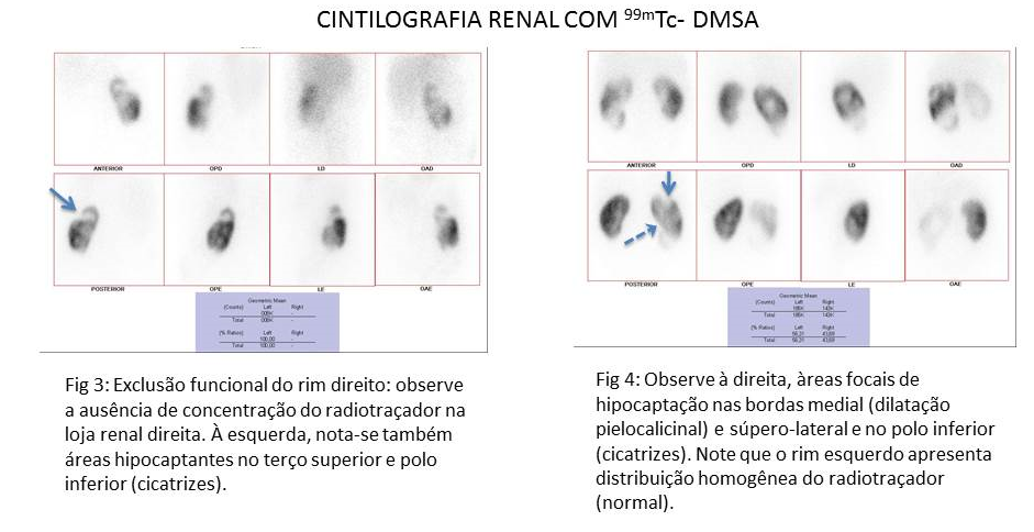 Cintilografia Renal Estática (Quantitativa/Qualitativa) - DMSA - Dimen ...